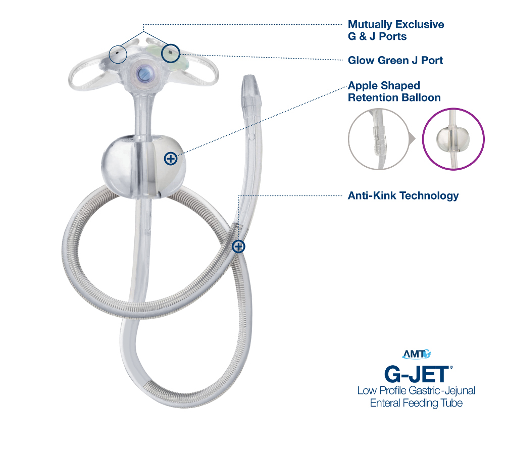 Different types of feeding tubes… – My Incredible Ivy