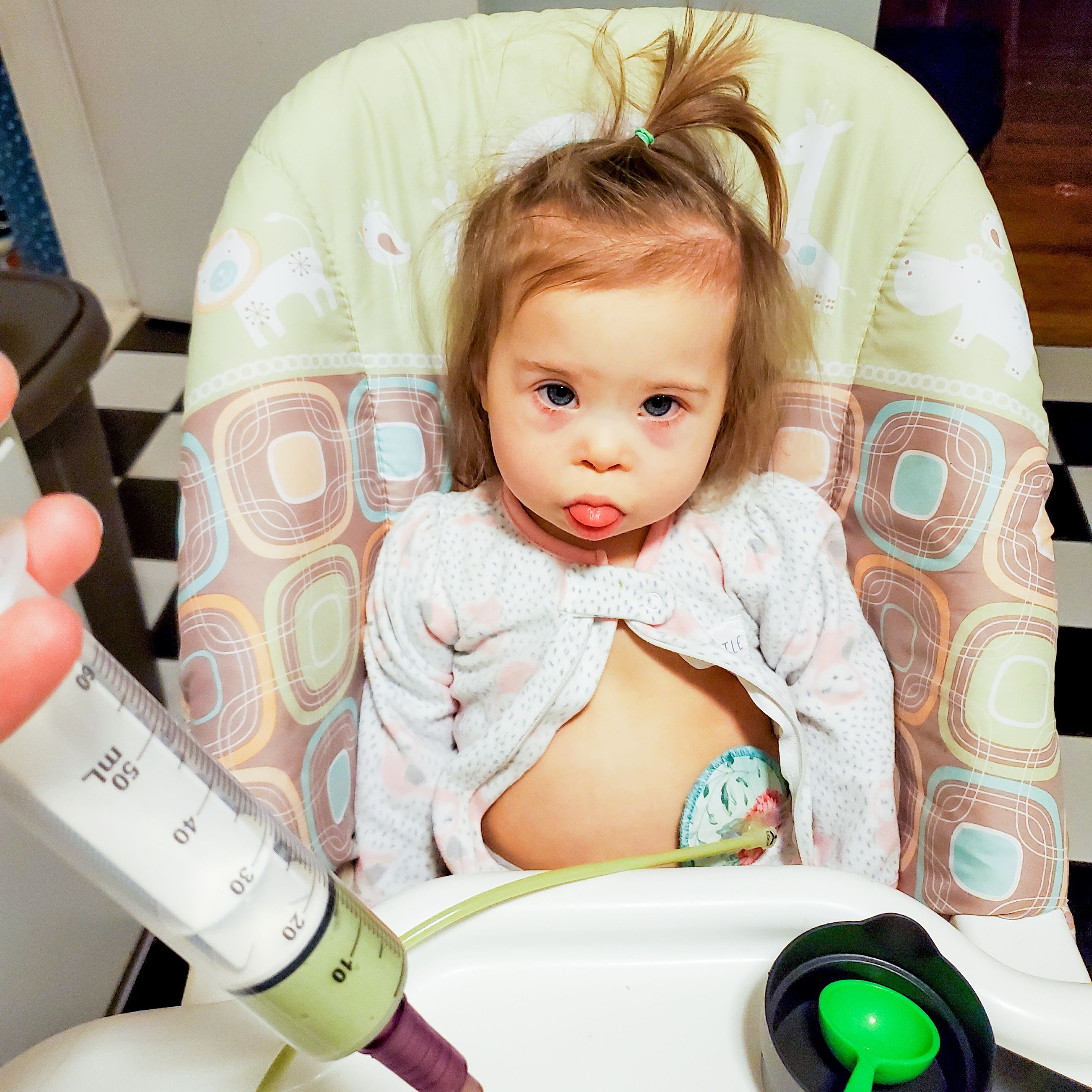 Different types of feeding tubes… – My Incredible Ivy